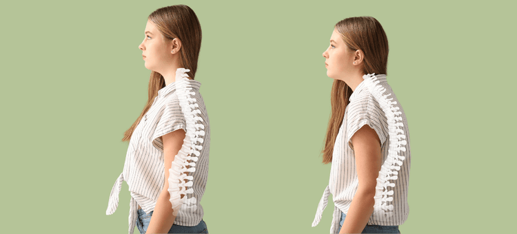 Hyperlordose : Comprendre et soigner la lordose lombaire | Blog Levalor ...